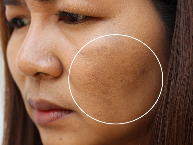 HA Skin Booster (Profhilo, Neauvia, Revok 50) - NOXClinic - Skin ...