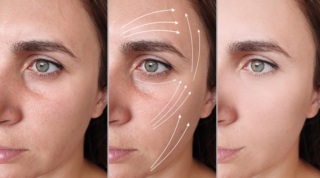 HA Skin Booster (Profhilo, Neauvia, Revok 50) - NOXClinic - Skin ...